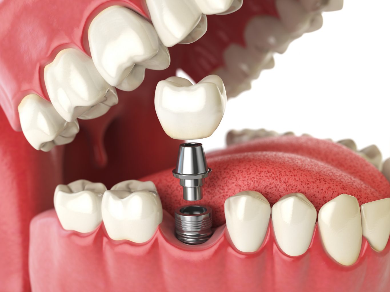 Dental Implants LP - Bright Star Sapphire Dental